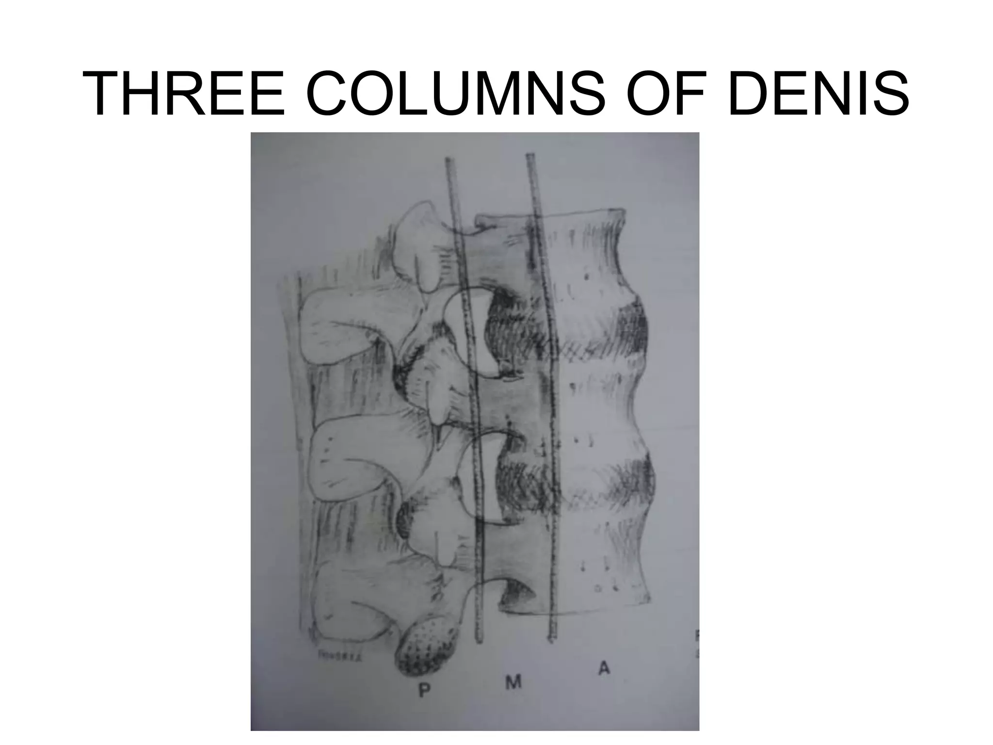 Classification and treament fracture of the spine | PPT