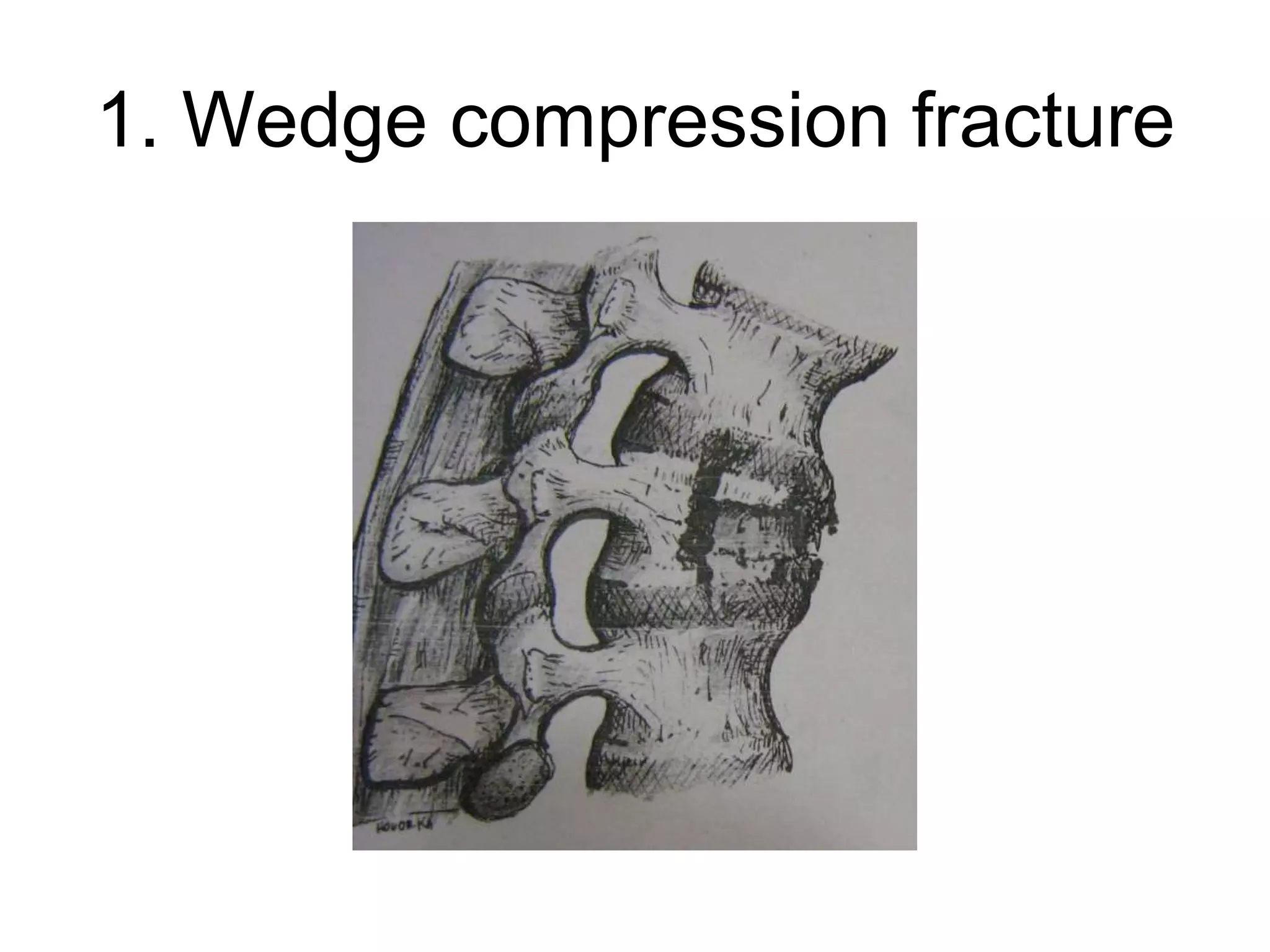 Classification and treament fracture of the spine | PPT
