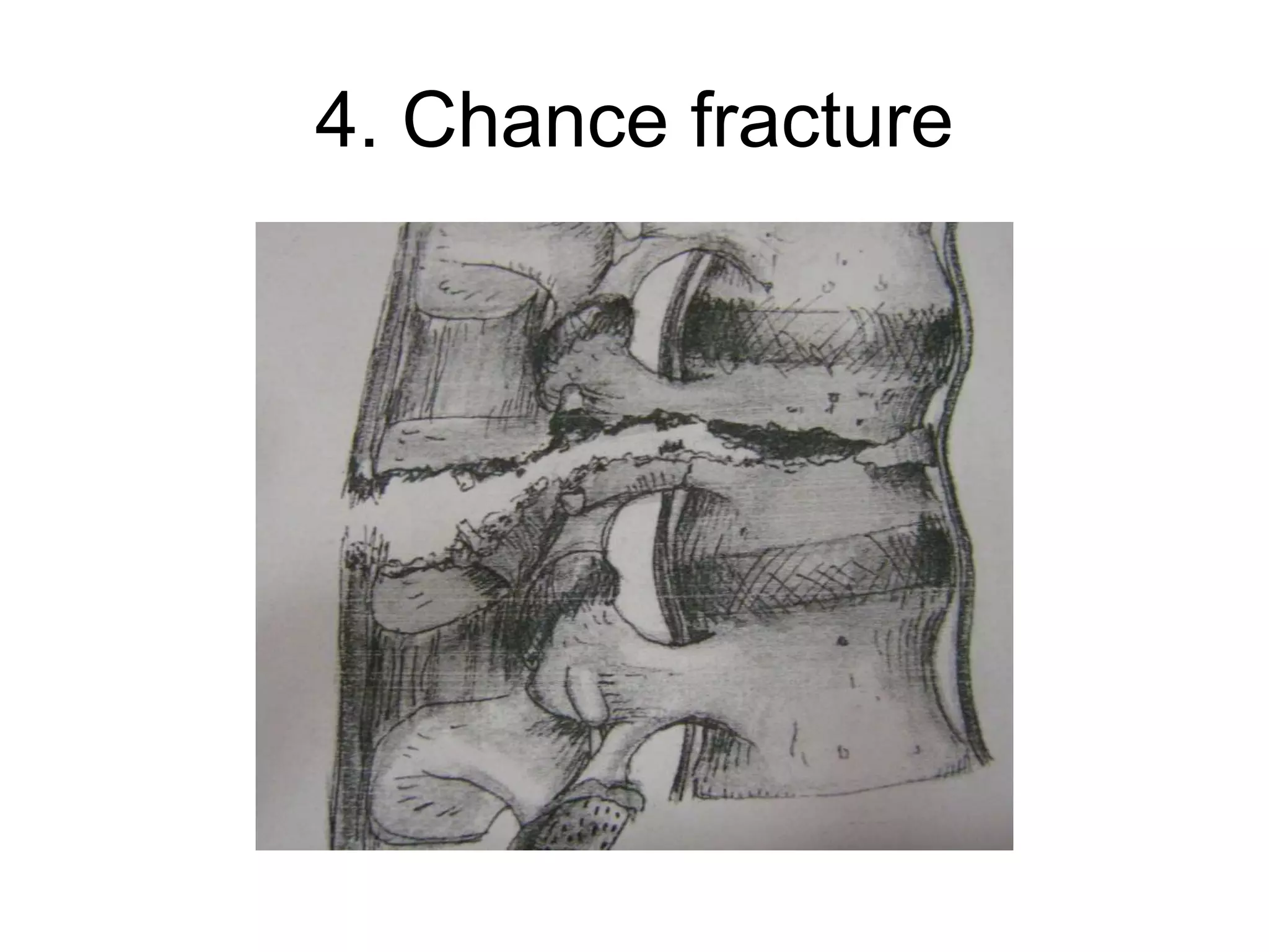 Classification and treament fracture of the spine | PPT