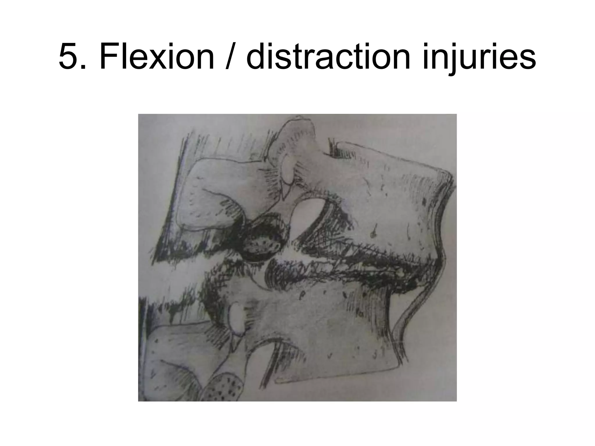 Classification and treament fracture of the spine | PPT