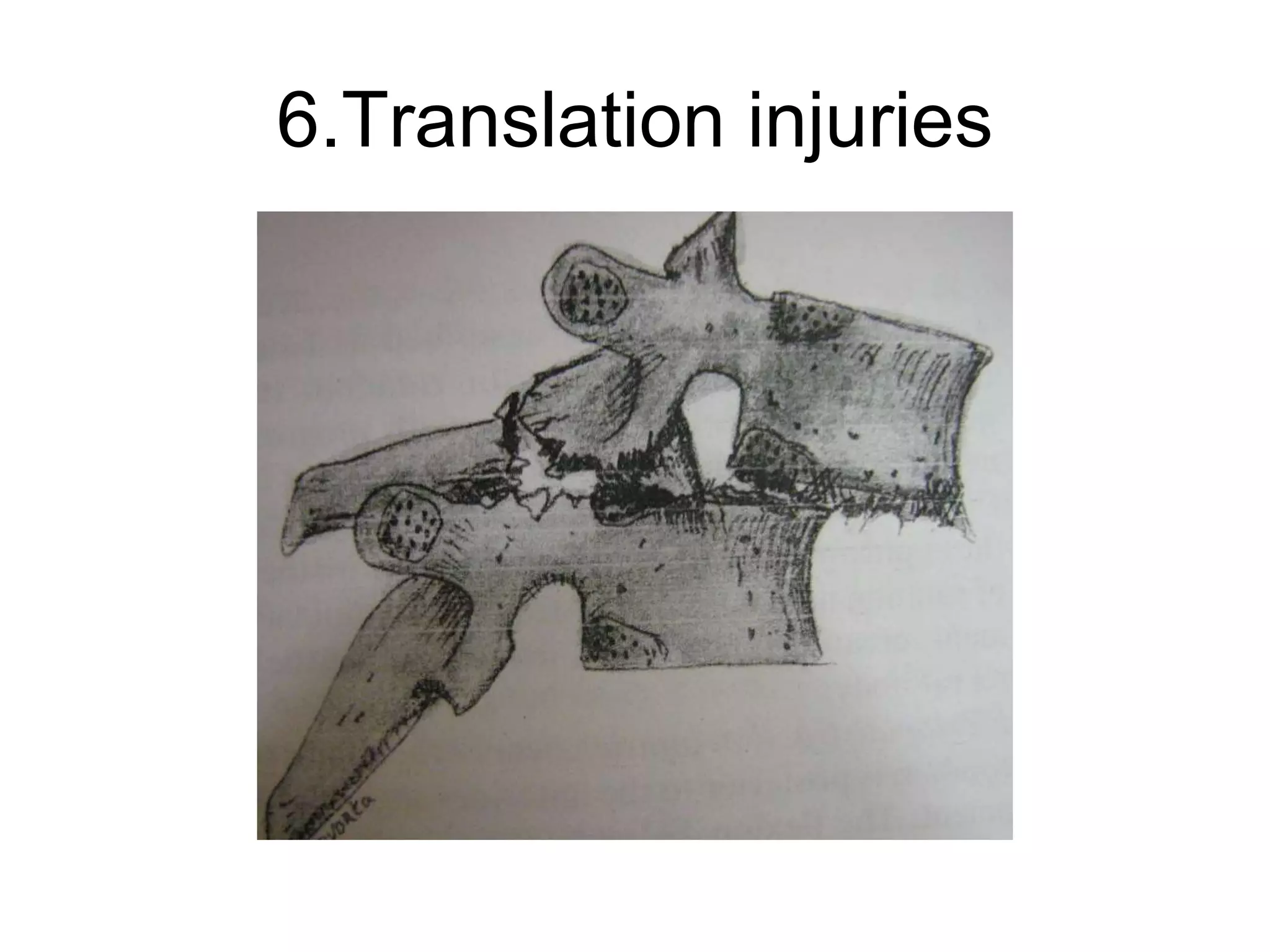 Classification and treament fracture of the spine | PPT