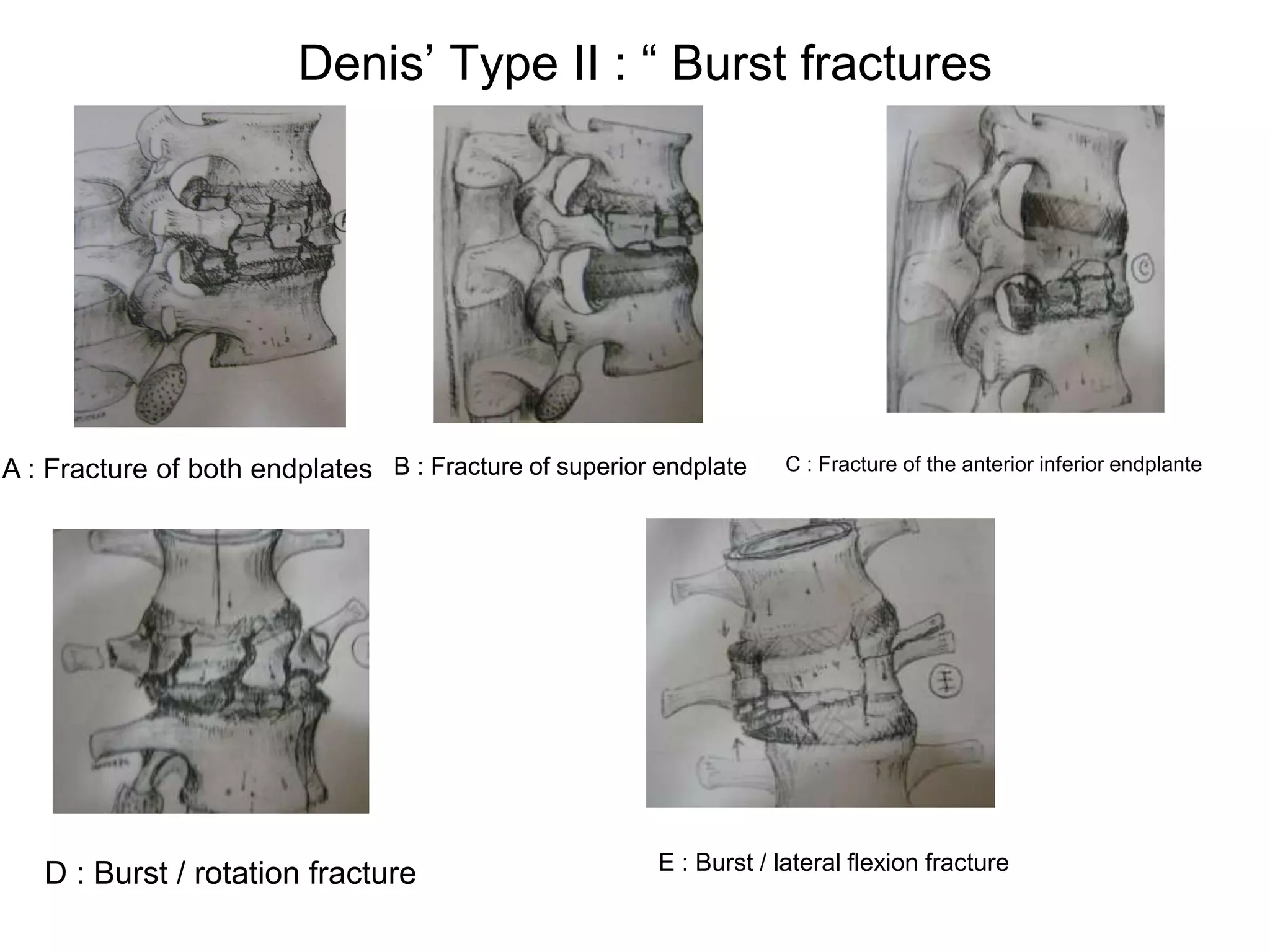 Classification and treament fracture of the spine | PPT