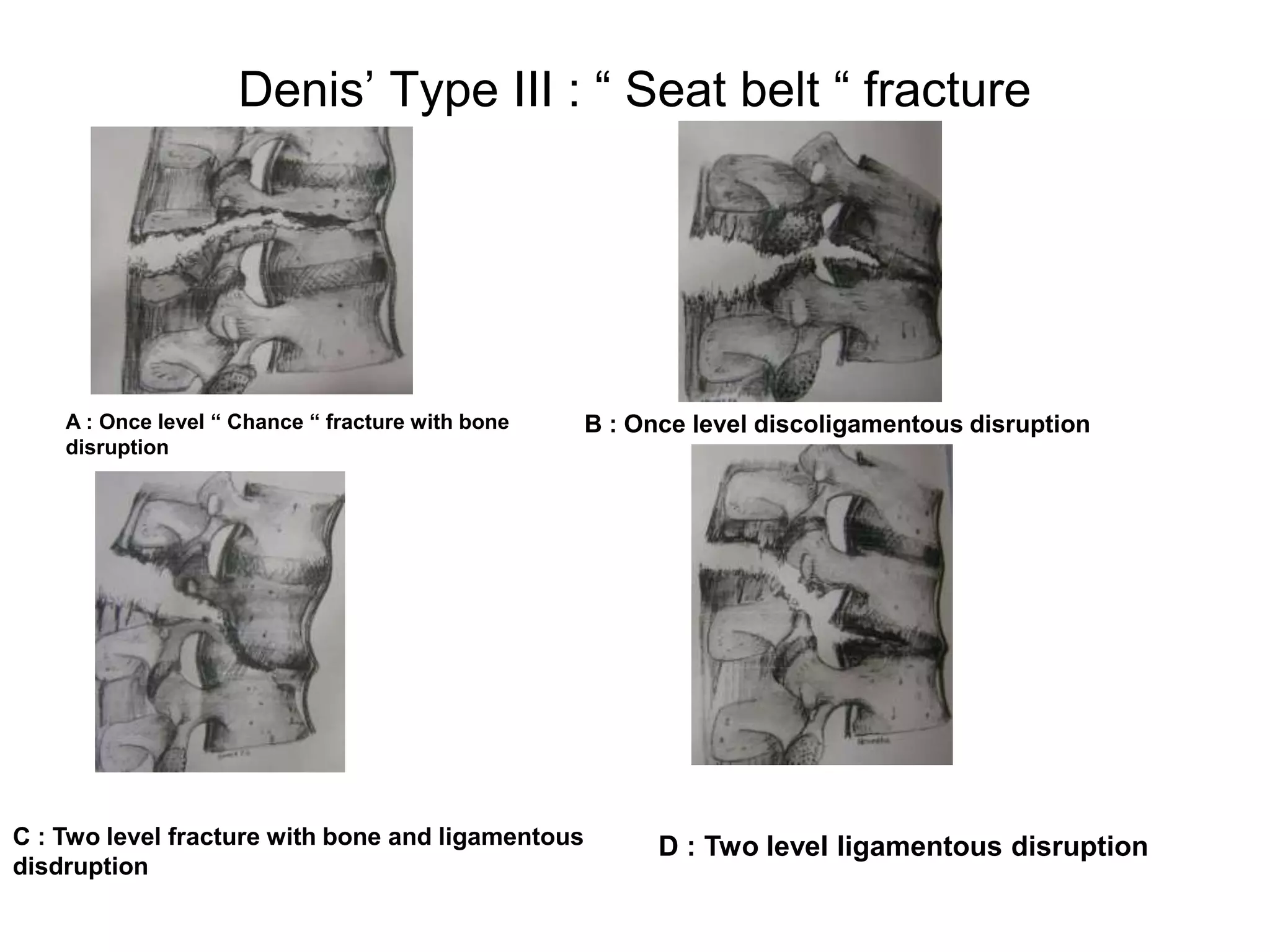 Classification and treament fracture of the spine | PPT