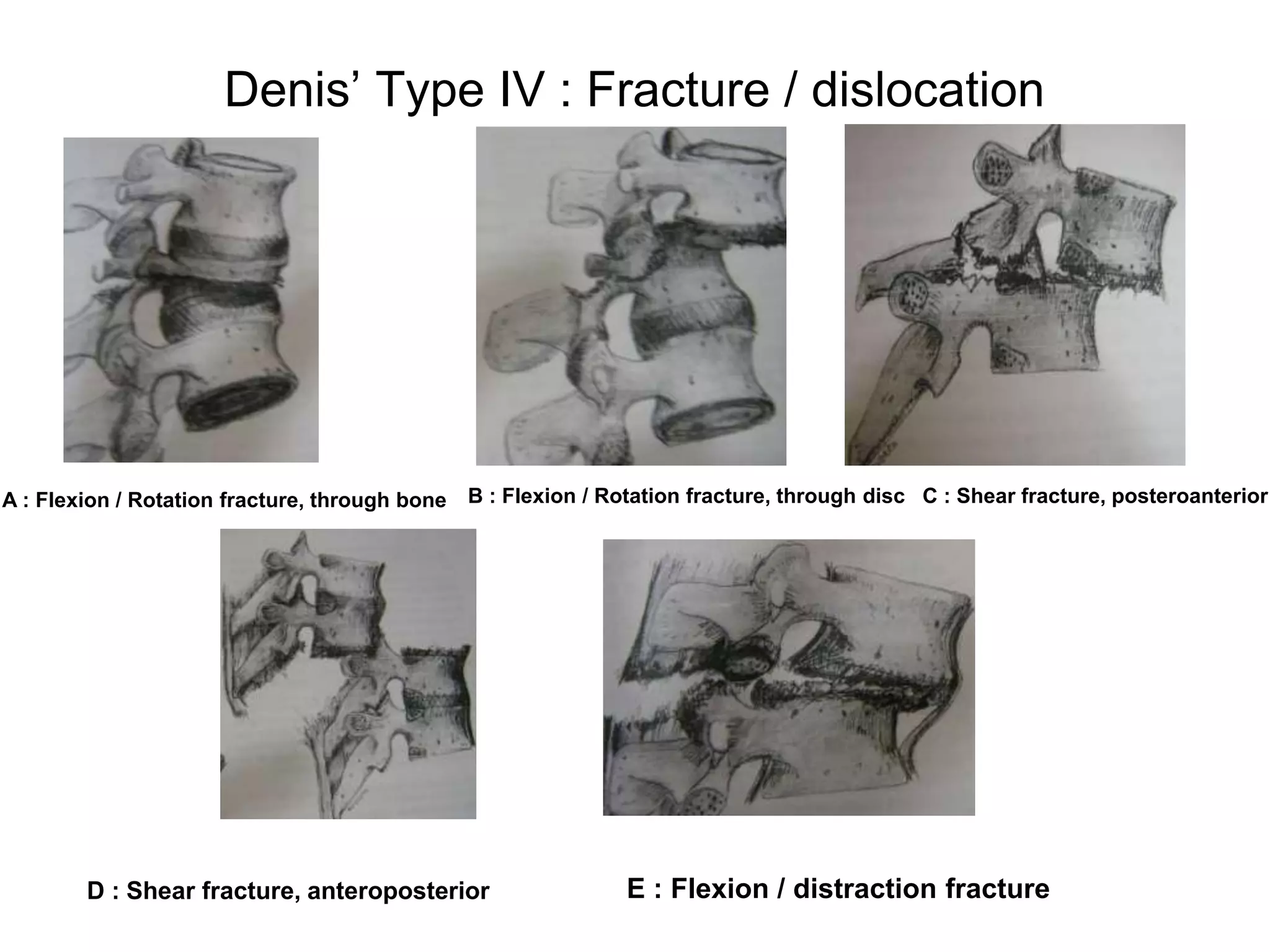 Classification and treament fracture of the spine | PPT