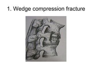 Classification and treament fracture of the spine | PPT