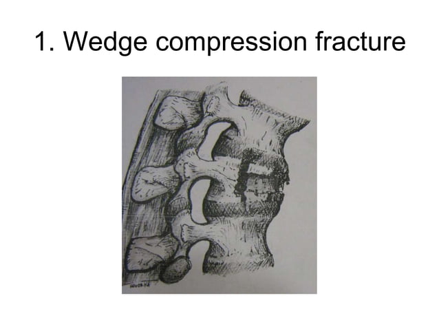 Classification and treament fracture of the spine | PPT