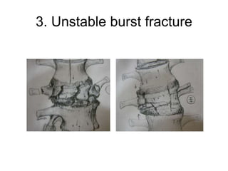 Classification and treament fracture of the spine | PPT