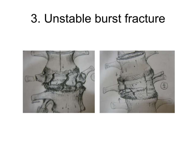 Classification and treament fracture of the spine | PPT