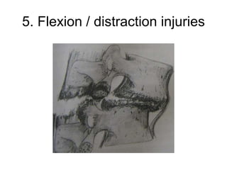 Classification and treament fracture of the spine | PPT