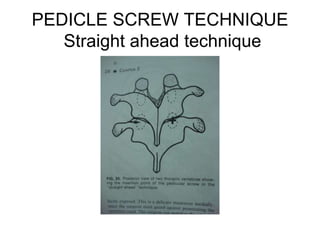 Classification and treament fracture of the spine | PPT