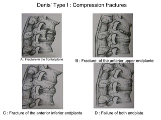 Classification and treament fracture of the spine | PPT