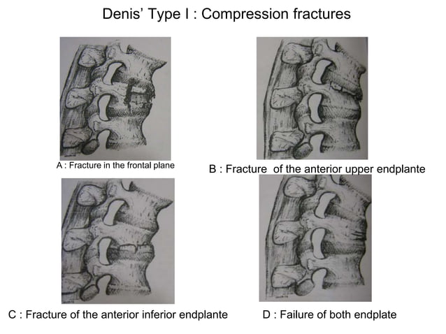 Classification and treament fracture of the spine | PPT