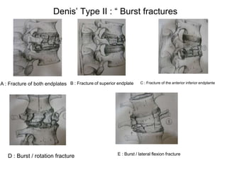 Classification and treament fracture of the spine | PPT