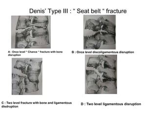 Classification and treament fracture of the spine | PPT