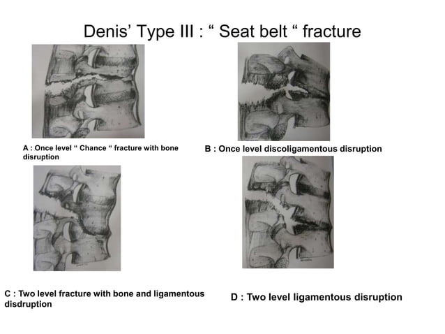 Classification and treament fracture of the spine | PPT