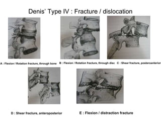 Classification and treament fracture of the spine | PPT