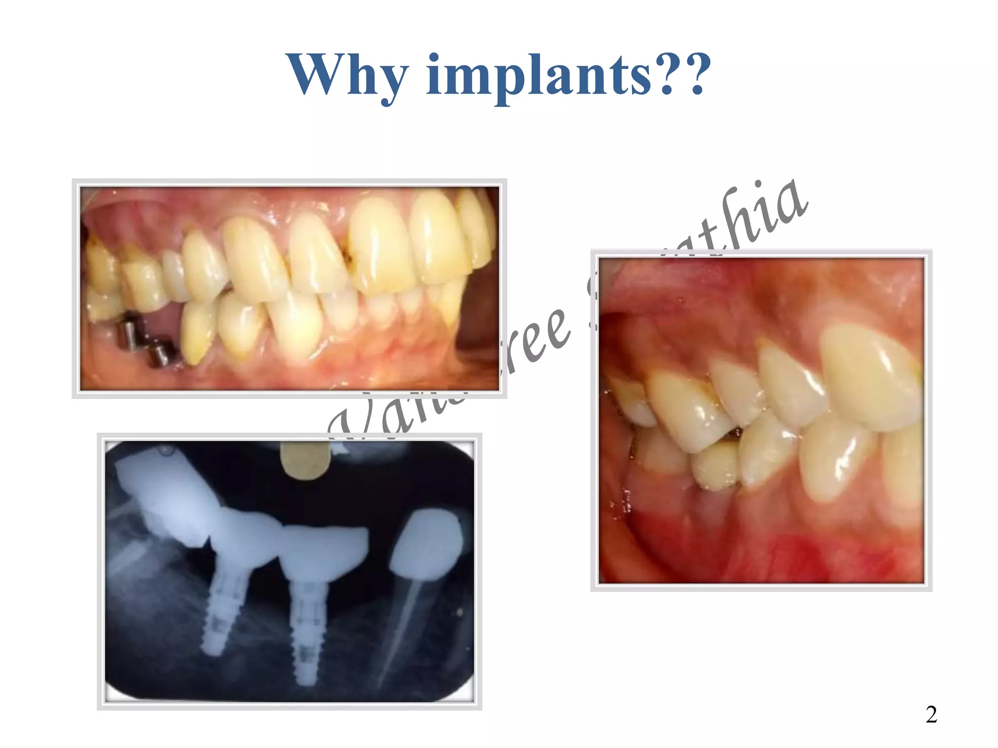 Classification and Types of Craniofacial Implants | PPTX