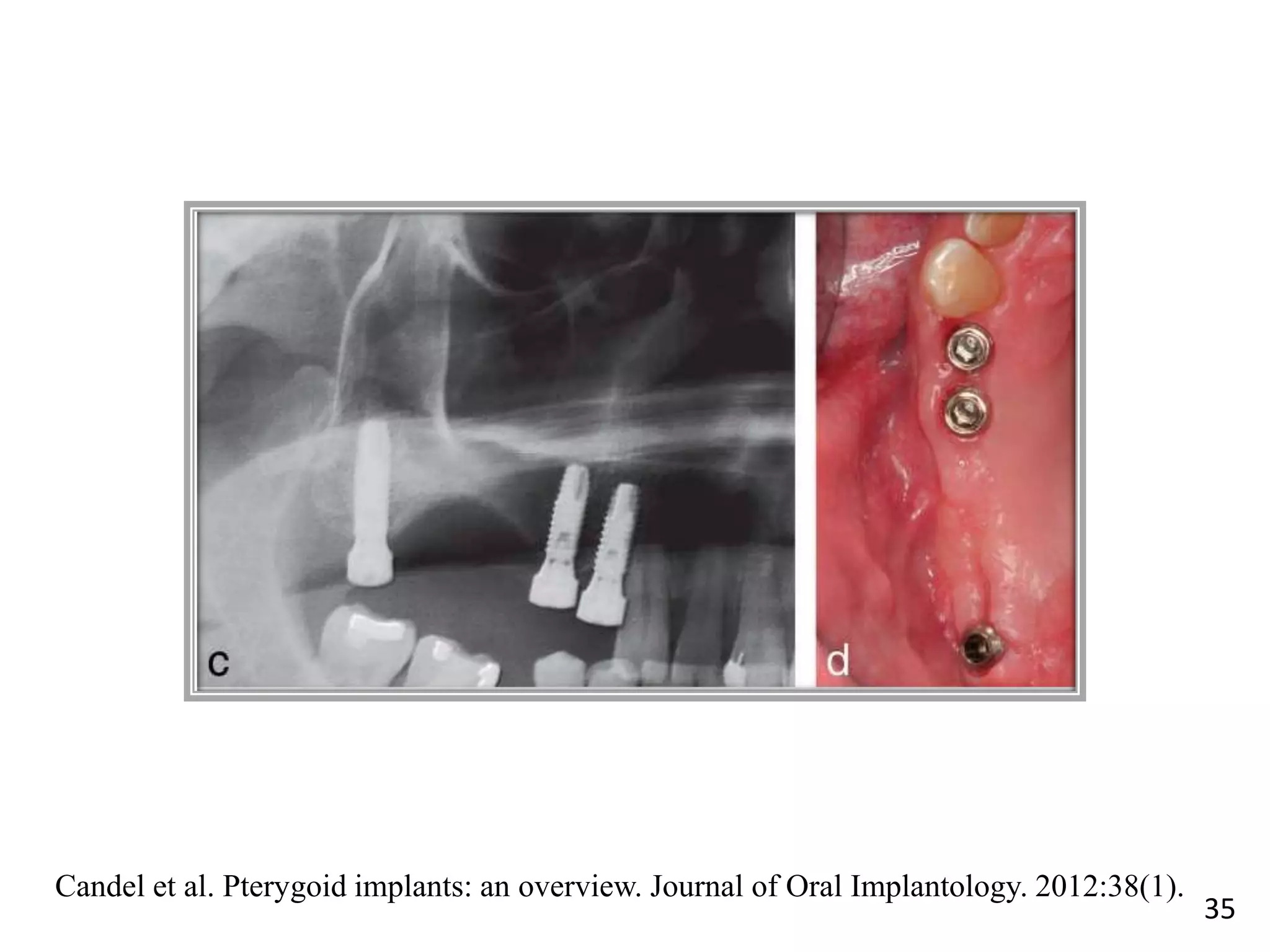 Classification and Types of Craniofacial Implants | PPTX