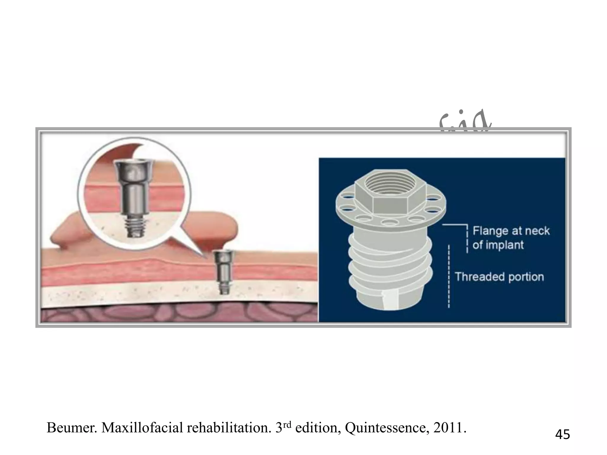 Classification and Types of Craniofacial Implants | PPTX