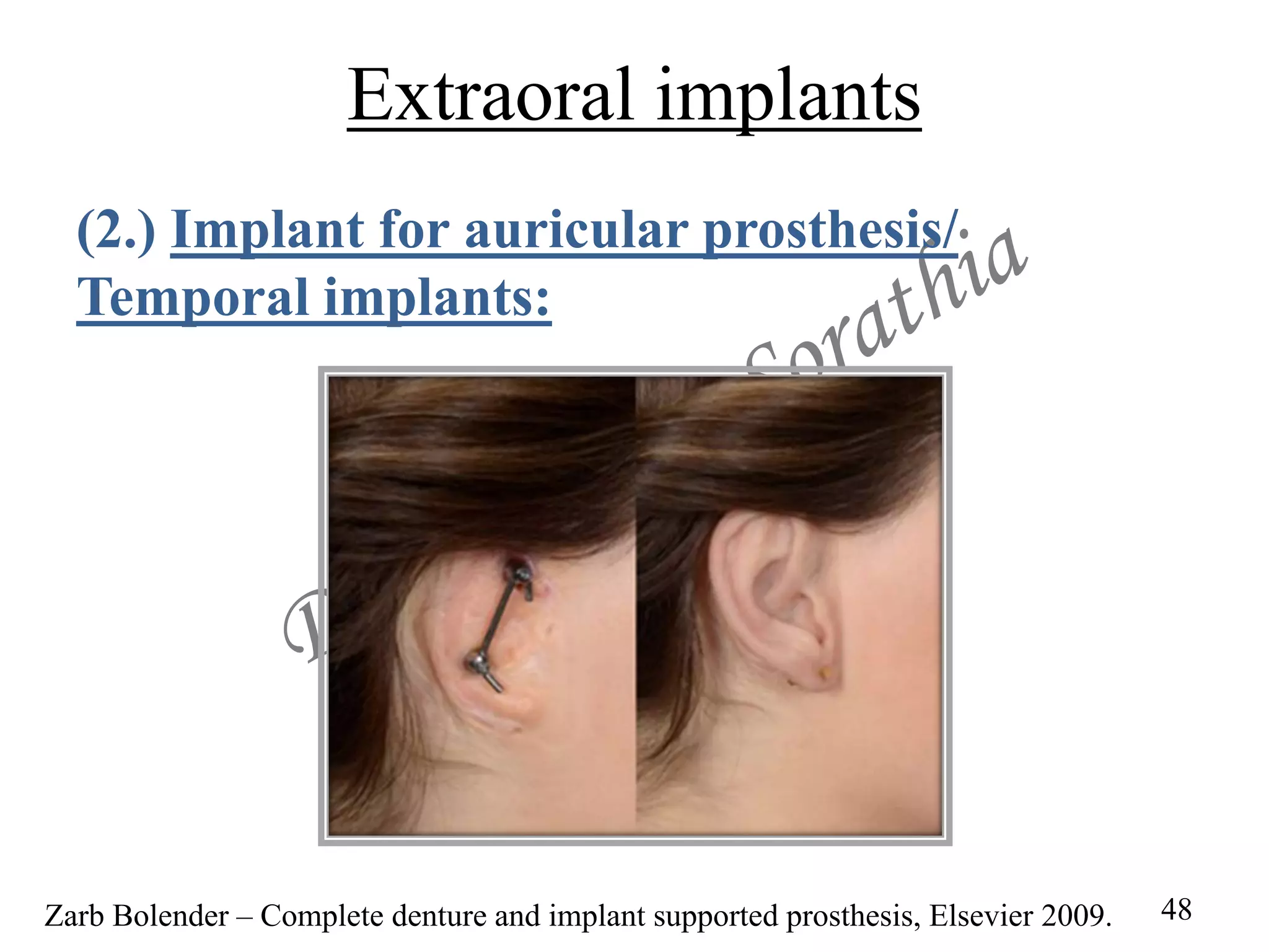 Classification and Types of Craniofacial Implants | PPTX