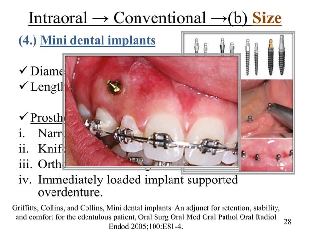 Classification and Types of Craniofacial Implants | PPTX | Oral care ...