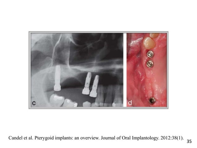 Classification and Types of Craniofacial Implants | PPTX | Oral care ...