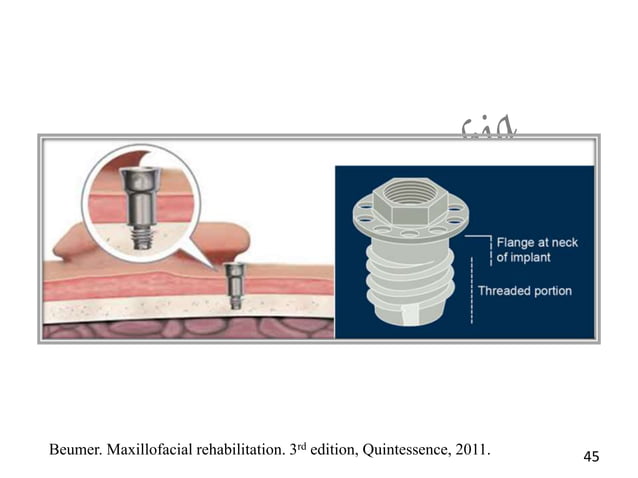 Classification and Types of Craniofacial Implants | PPTX | Oral care ...
