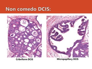 Classification breast tumour | PPTX