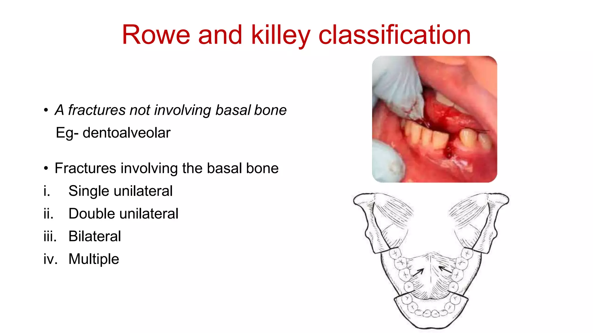 Classification, clinical features of pan facial trauma | PPTX