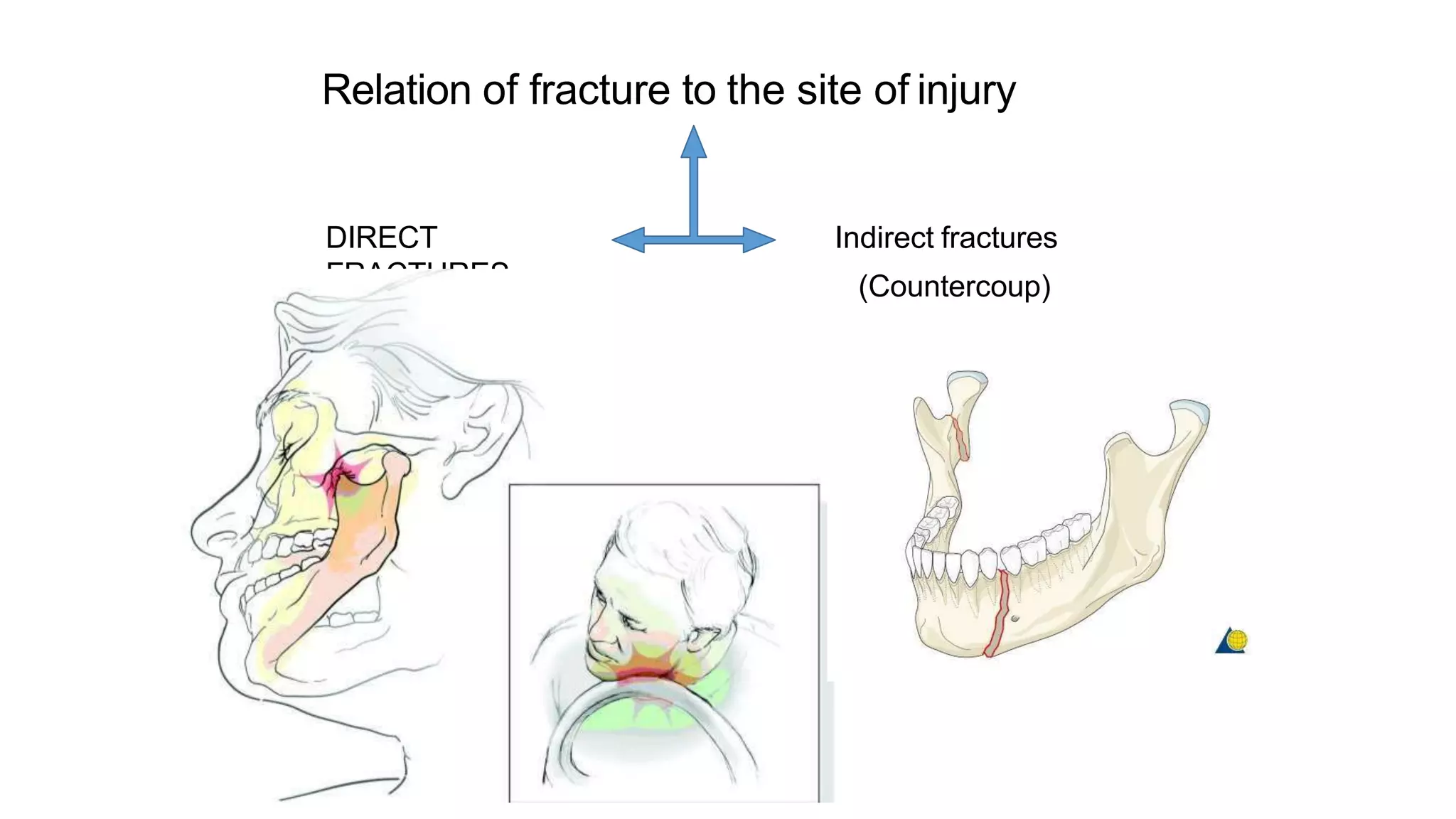 Classification, clinical features of pan facial trauma | PPTX