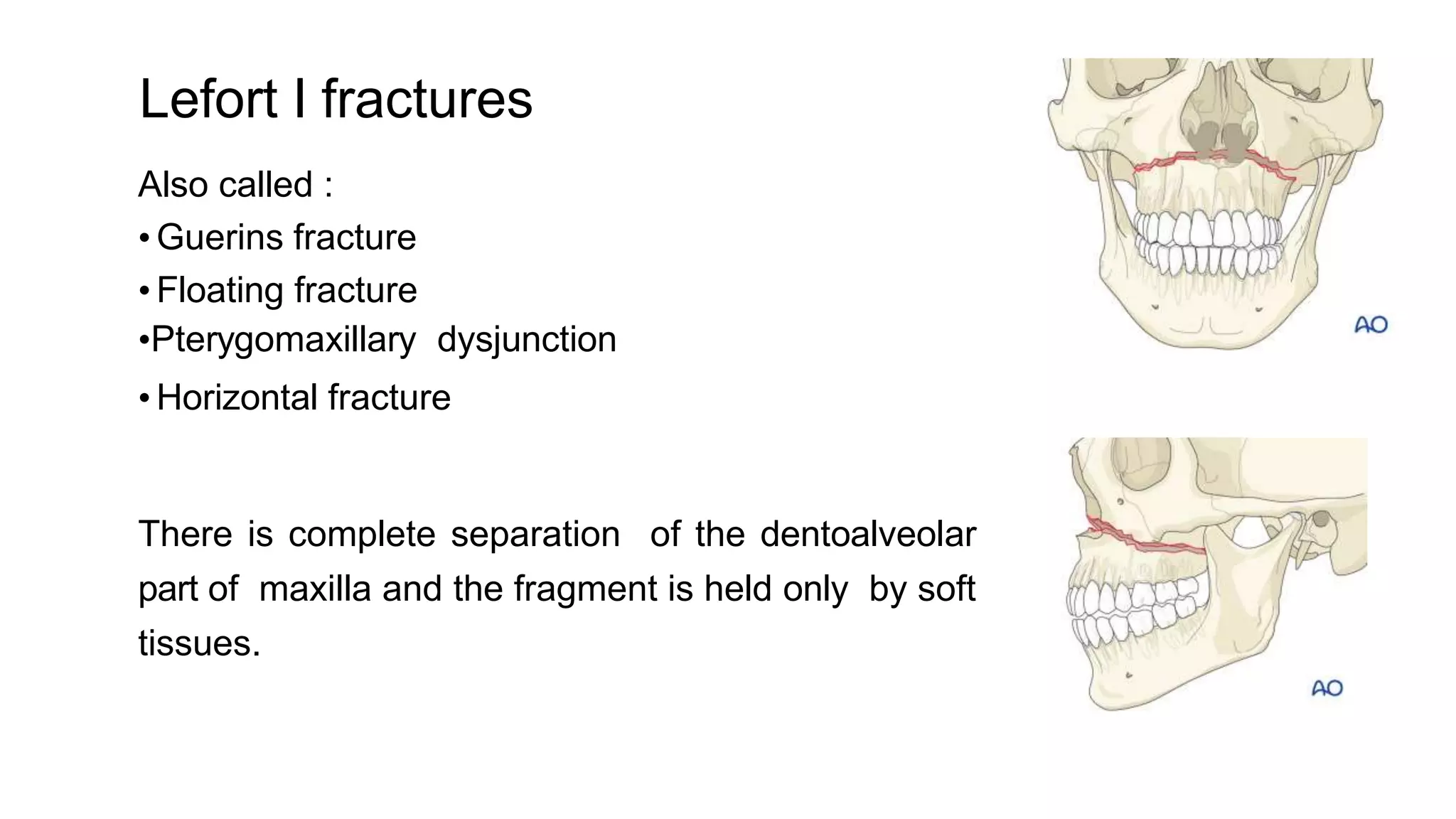 Classification, clinical features of pan facial trauma | PPTX