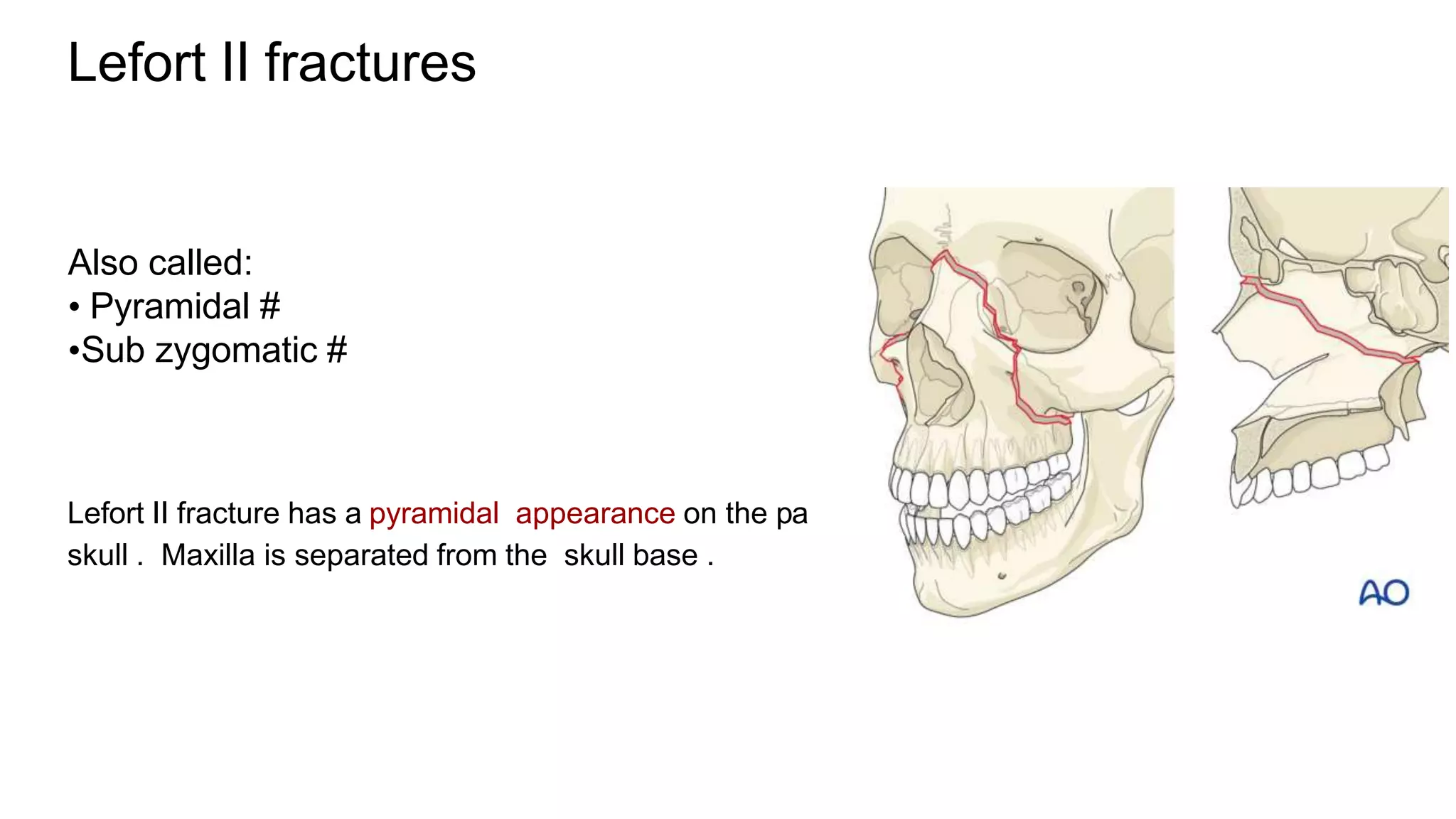 Classification, clinical features of pan facial trauma | PPTX