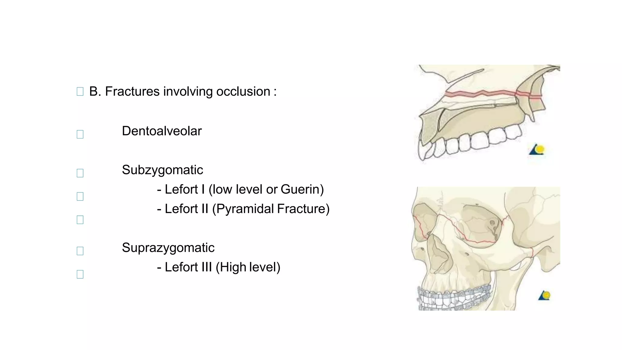 Classification, clinical features of pan facial trauma | PPTX