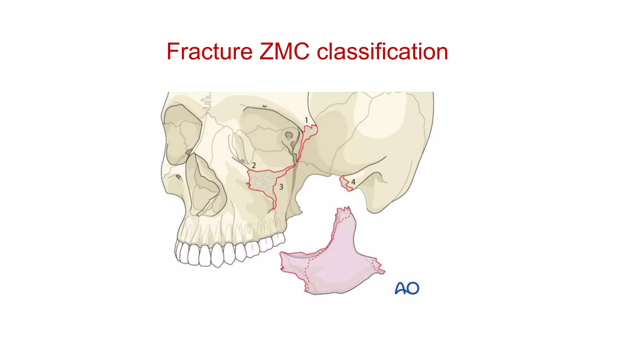 Classification, clinical features of pan facial trauma | PPTX