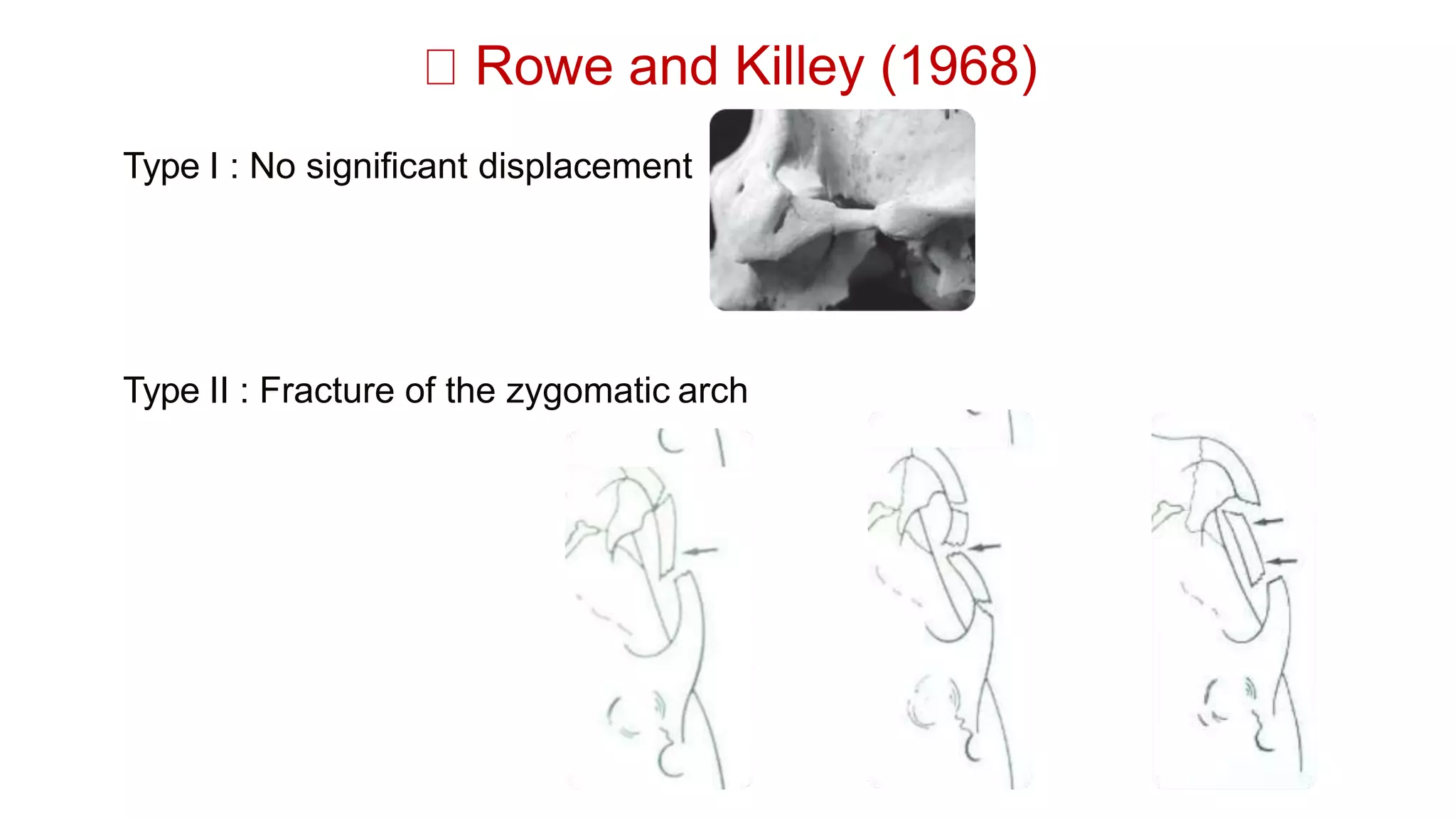 Classification, clinical features of pan facial trauma | PPTX