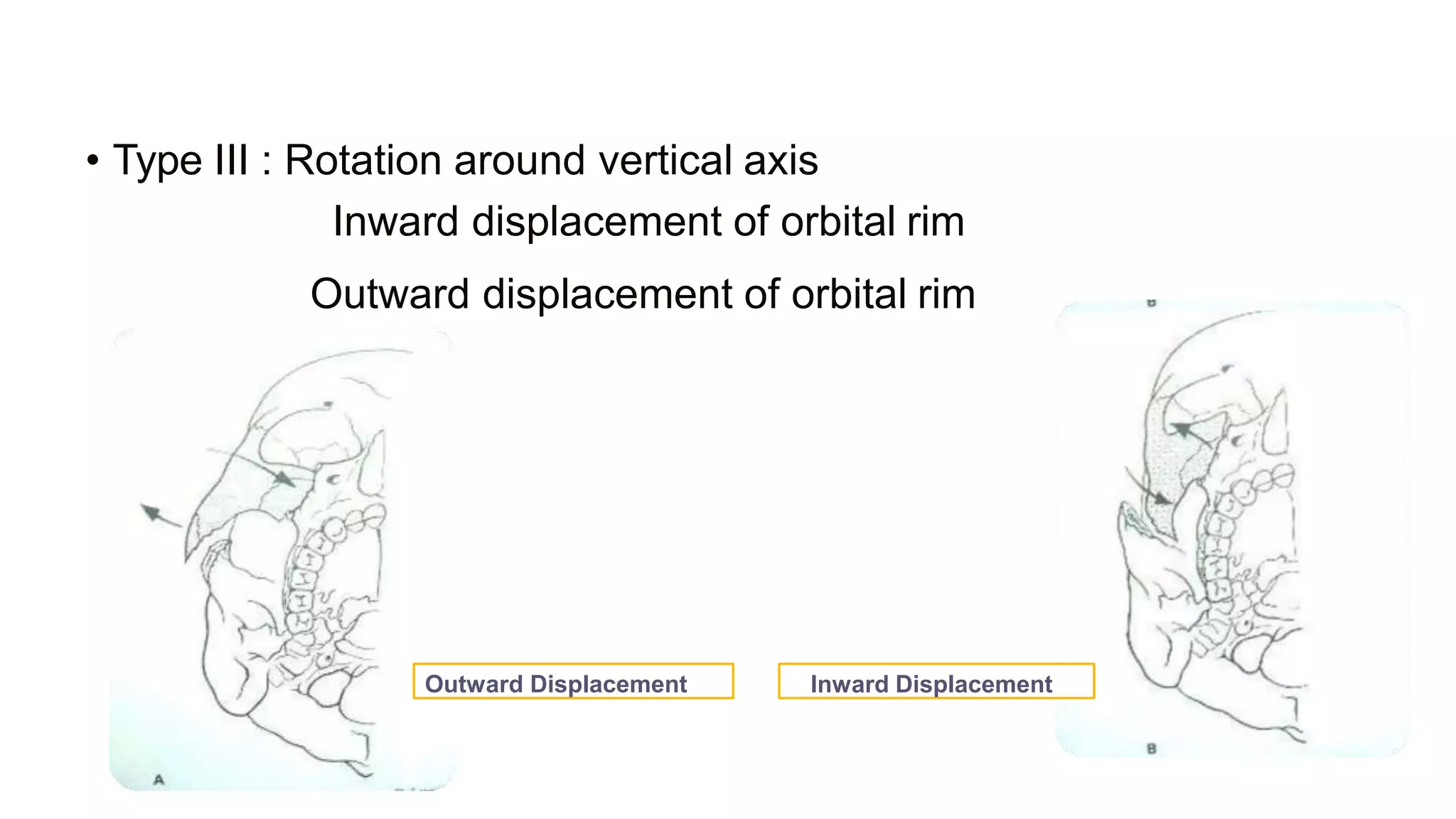 Classification, clinical features of pan facial trauma | PPT