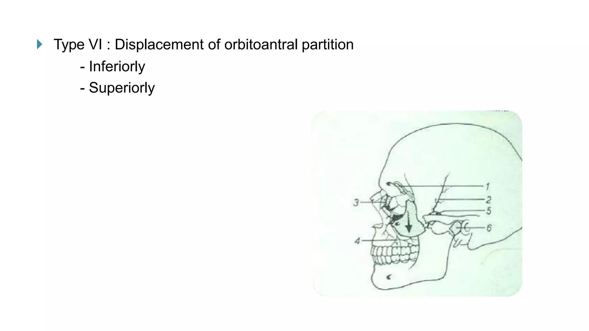 Classification, clinical features of pan facial trauma | PPTX