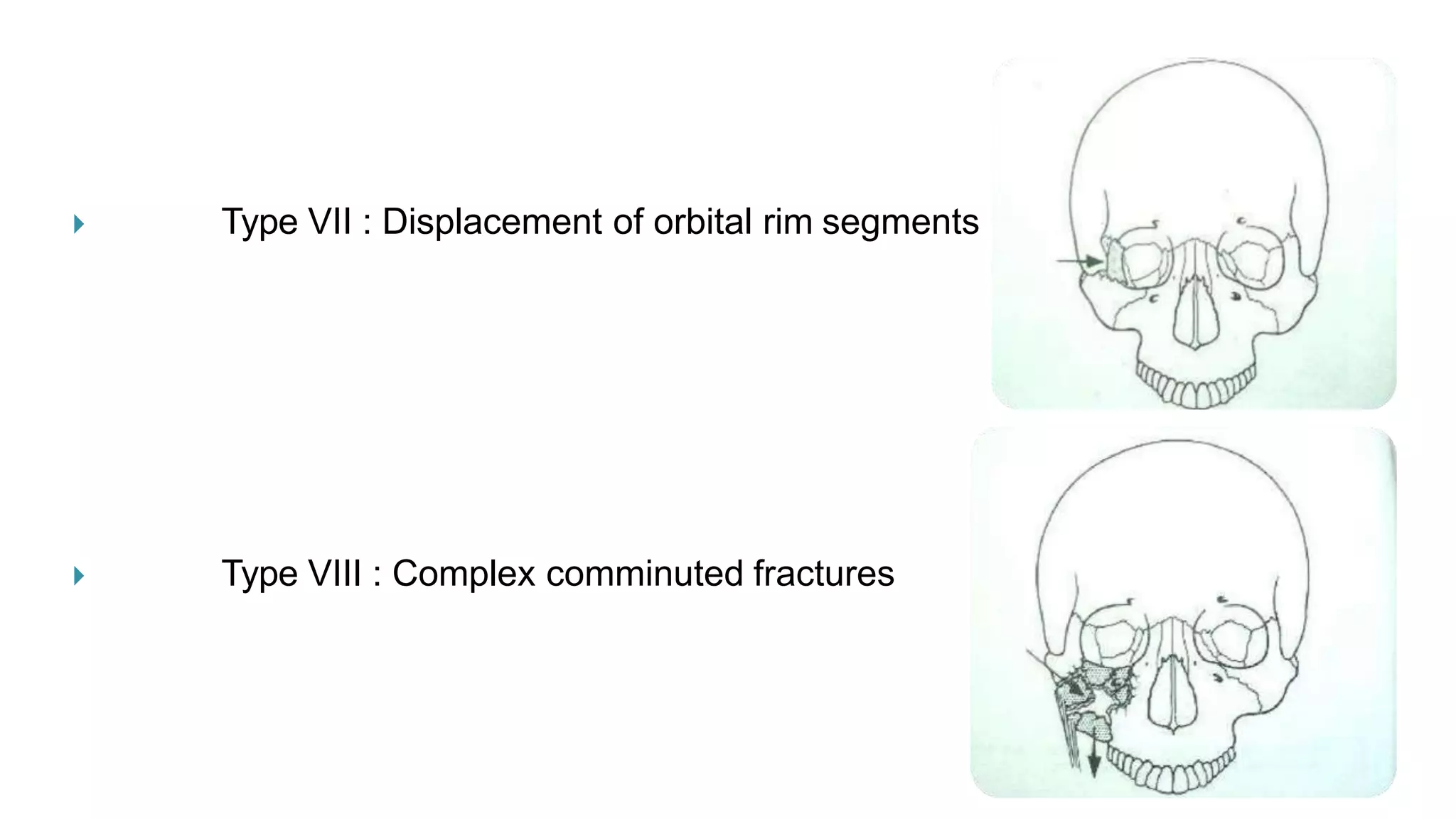 Classification, clinical features of pan facial trauma | PPTX