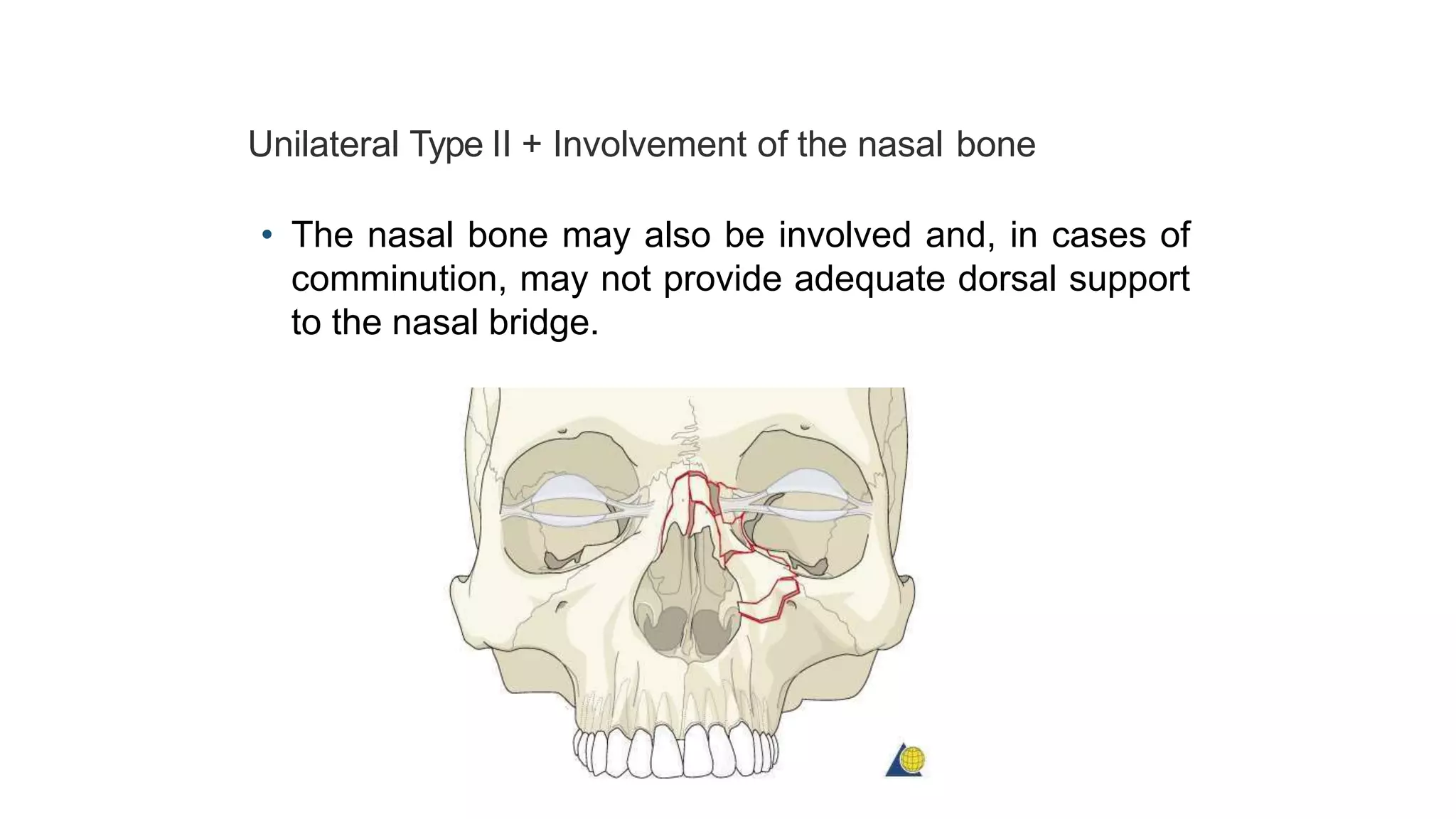 Classification, clinical features of pan facial trauma | PPTX