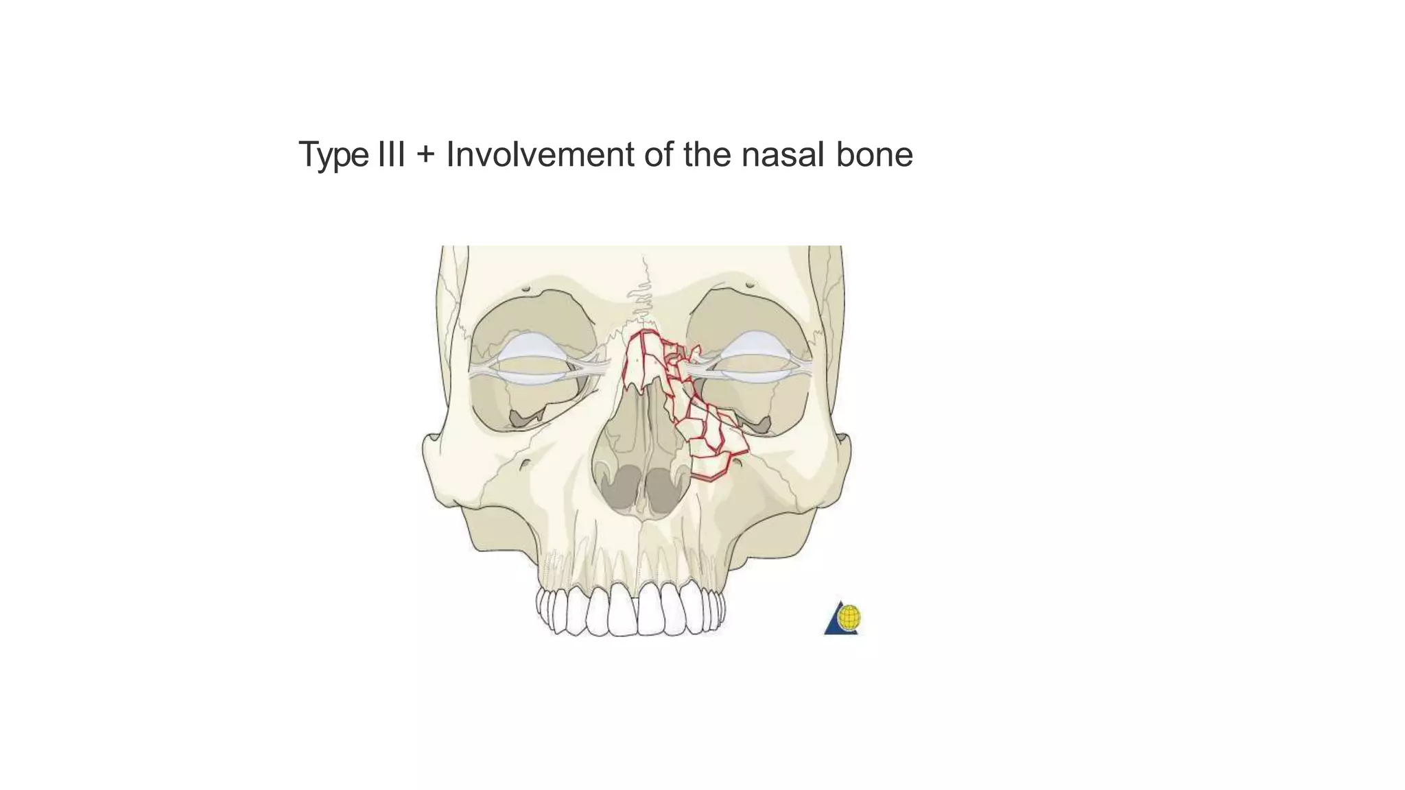 Classification, clinical features of pan facial trauma | PPTX