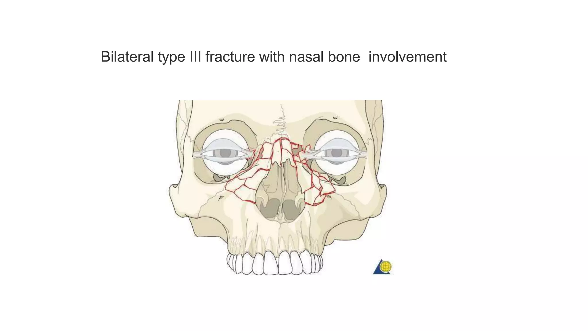 Classification, clinical features of pan facial trauma | PPTX