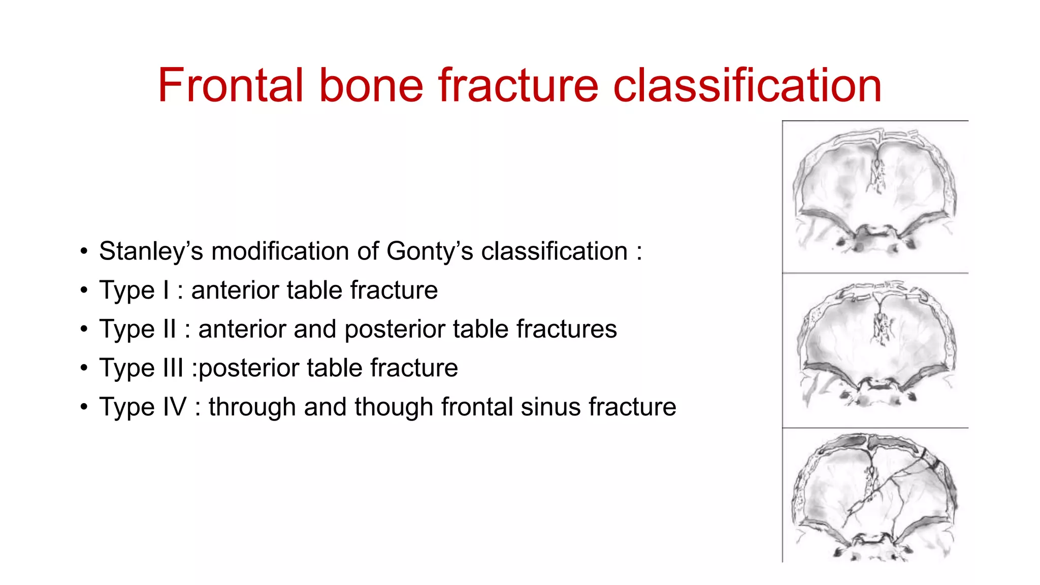 Classification, clinical features of pan facial trauma | PPTX