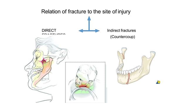 Classification, clinical features of pan facial trauma | PPTX