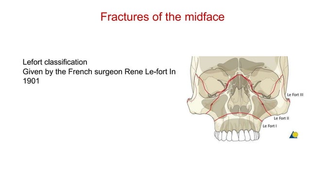 Classification, clinical features of pan facial trauma | PPTX