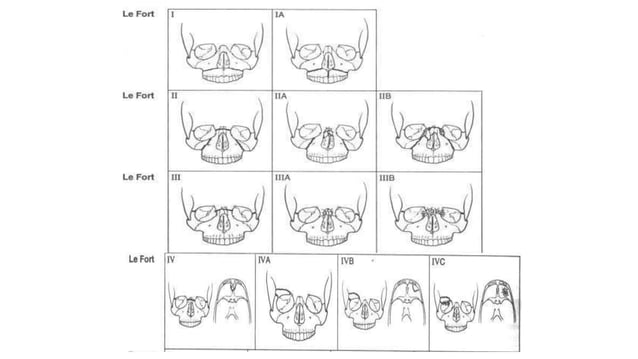 Classification, clinical features of pan facial trauma | PPTX