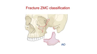Classification, clinical features of pan facial trauma | PPTX