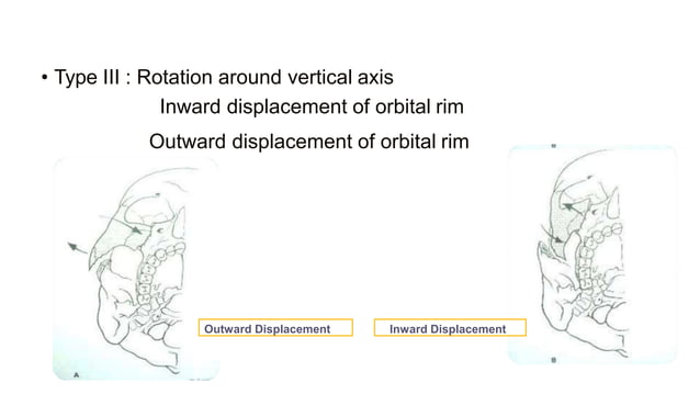 Classification, clinical features of pan facial trauma | PPTX
