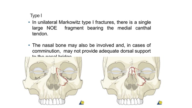 Classification, clinical features of pan facial trauma | PPTX