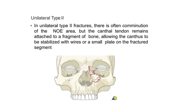 Classification, clinical features of pan facial trauma | PPTX