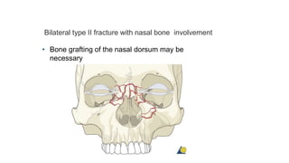 Classification, clinical features of pan facial trauma | PPTX